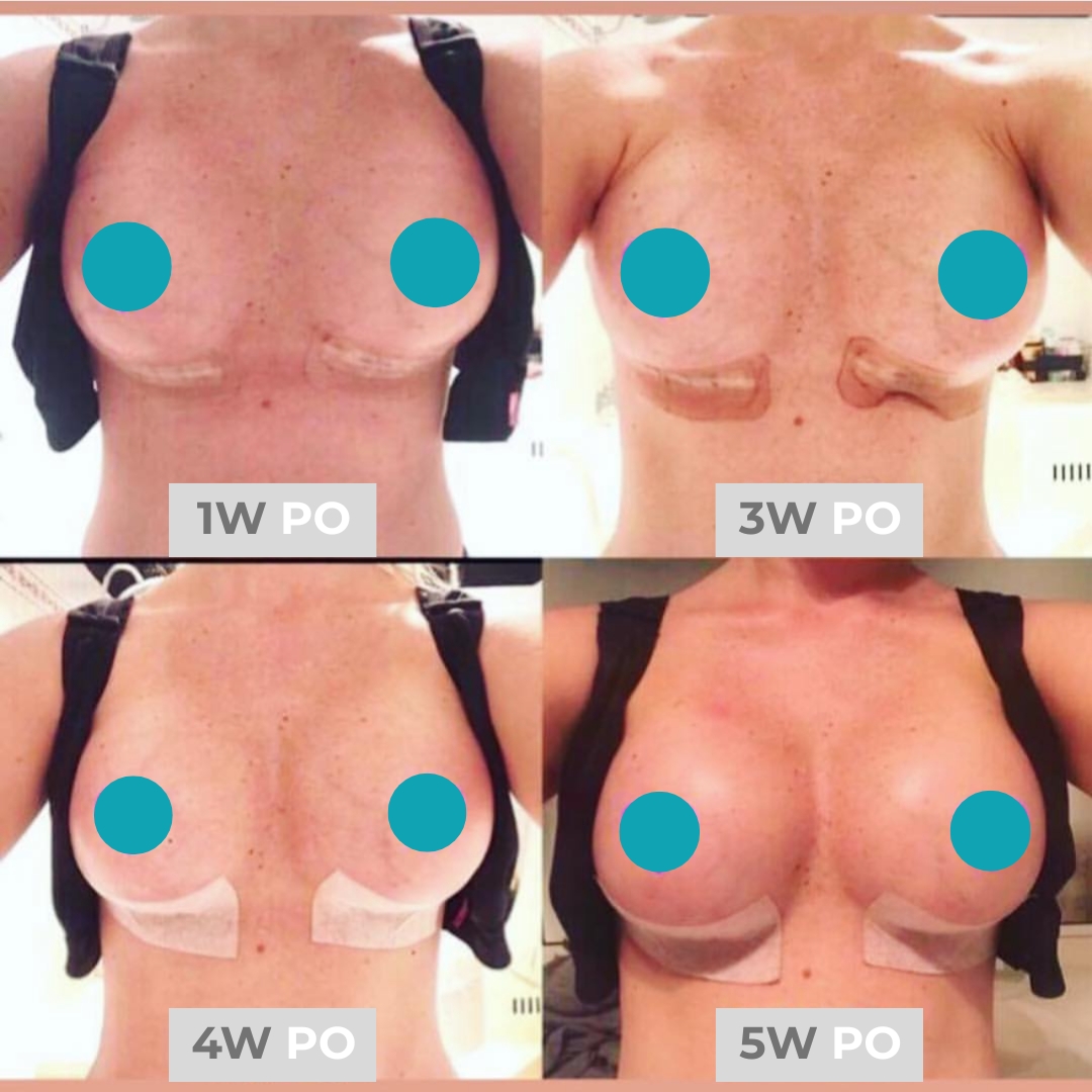 Breast Implants After Surgery